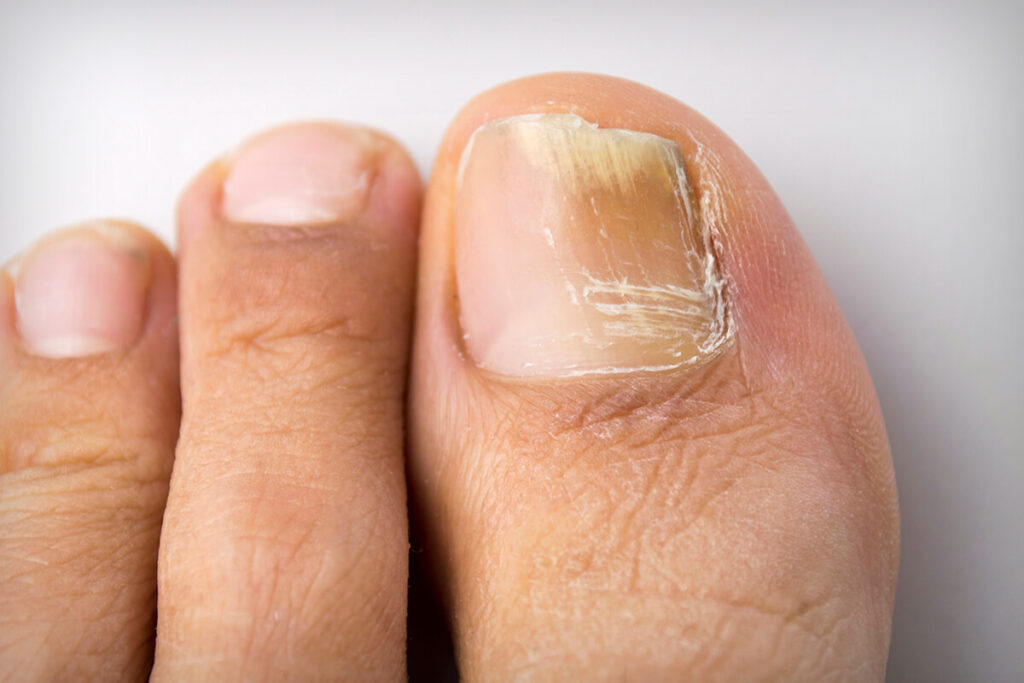 FODPROBLEMER – Klinik For Fodterapi – Fodterapeuter i Farsø